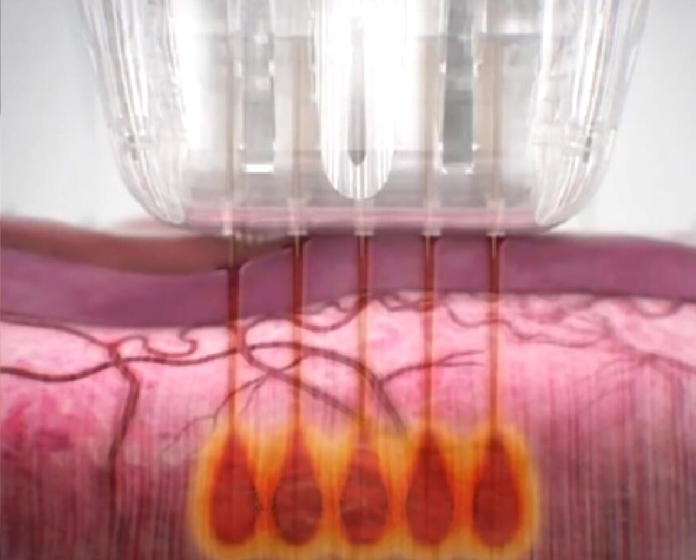 Secret RF Microneedling